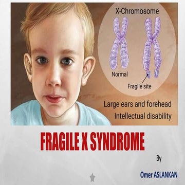 fragile x syndrome.pptx