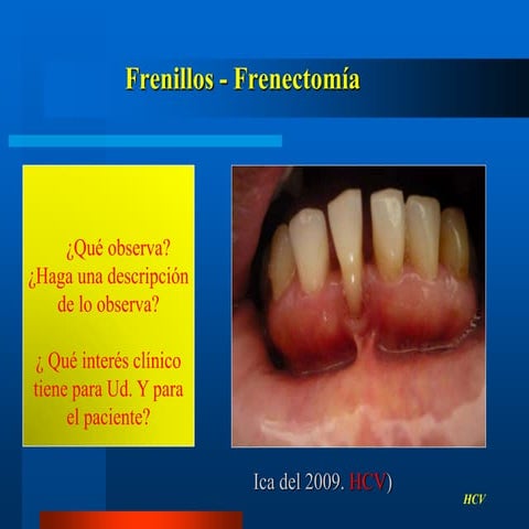 Frenillos - Frenectomia.cirugia basica y metodos | PPTX