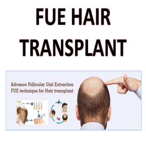 Fue hair transplant | PPTX