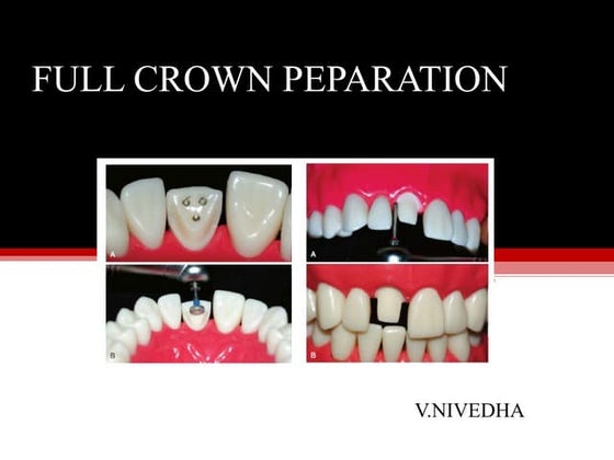 Zirconia crown preparation | PDF