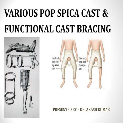 Functional cast bracing and various pop spica cast | PPTX