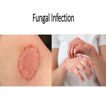 Fungal Infection (pharmacology and rehab) | PPTX