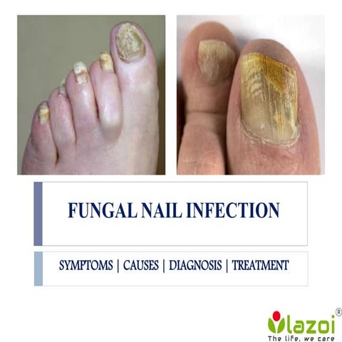 Fungal Nail Infection: causes, symptoms, diagnosis and treatment | PPTX
