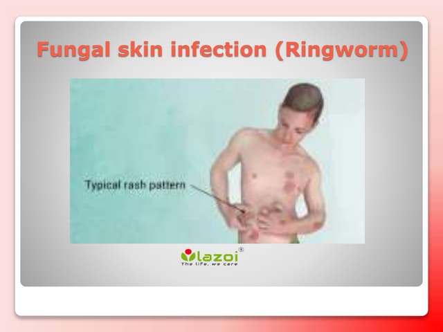 Ringworm | PPTX