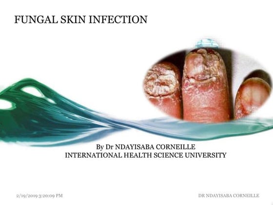 Fungal infection of skin | PPT