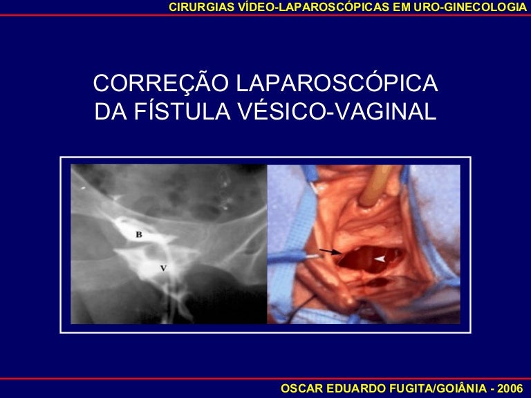 Correção Laparoscópica da Fístula Vésico-vaginal