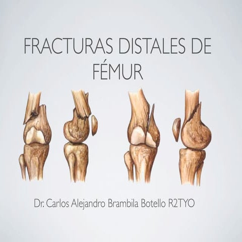 Fracturas de Femur Distal | PPT