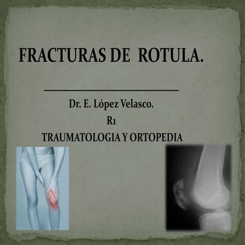 Fx rotula | PPTX