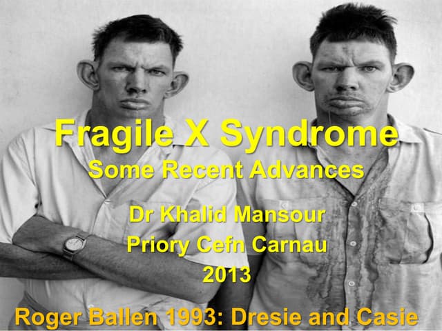 Fragile x syndrome | PPTX