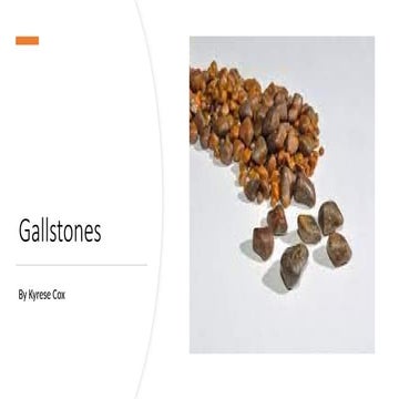 Gallstone Presentation about kidnesy and stiud | PPT