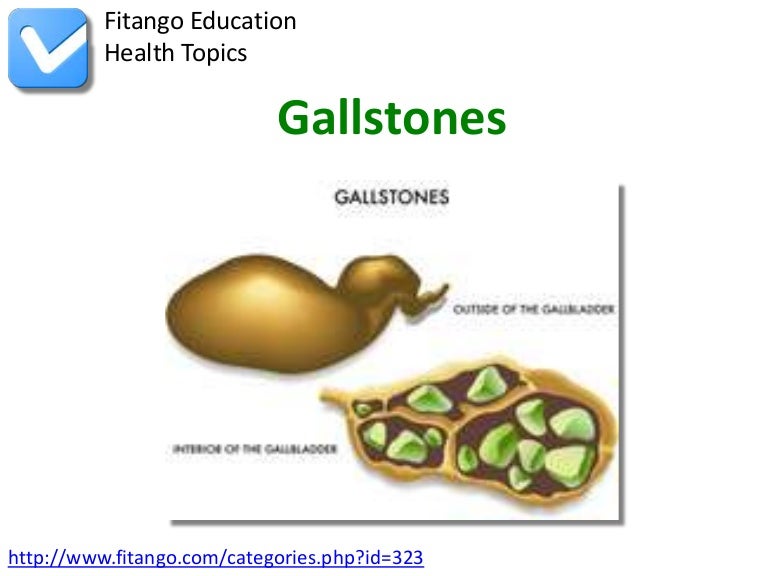 Gallstones