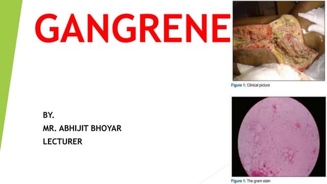 Gangrene #Types of gangrene | PPTX