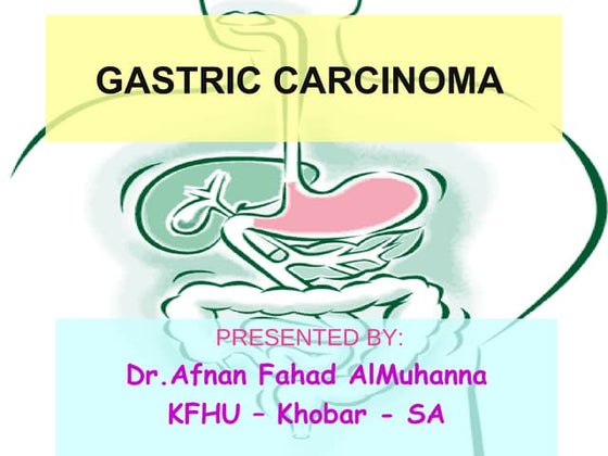 Gastric cancer | PPT
