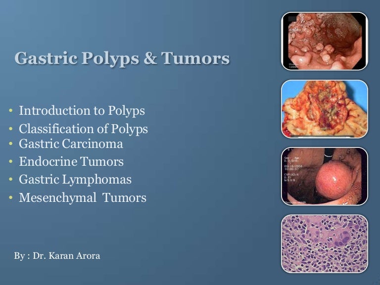 Gastric polyps & tumors by Dr. Karan Arora