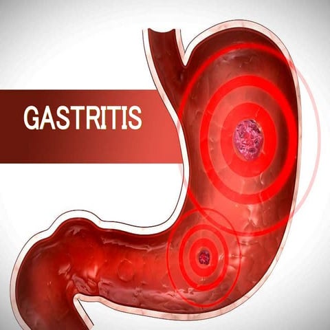 GASTRITIS.pptx