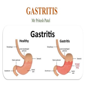 ACUTE VS CHRONIC GASTRITIS AND MANAGEMENT | PPTX