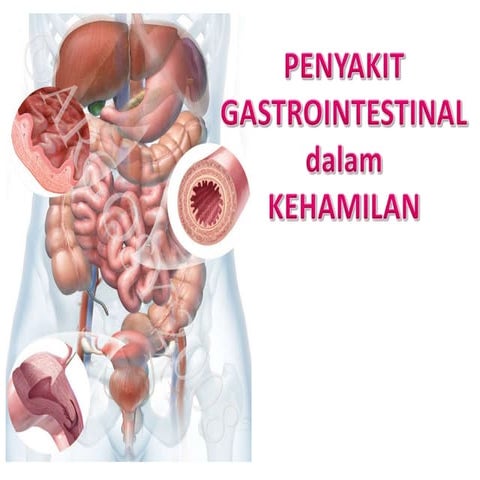 GASTRO KEHAMILAN ADALAH PENYAKIT DALAM KEHAMILAN.pptx