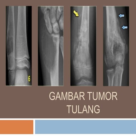 Gbr bimb tumor tulang | PPT