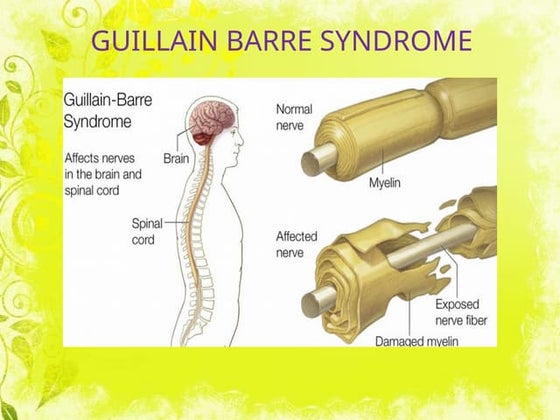 Guillain Barre Syndrome (GBS) | PPT