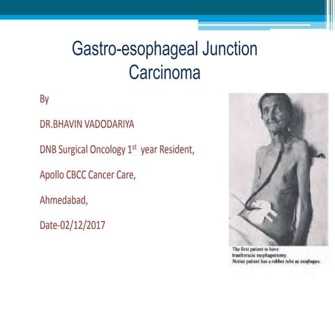 Gastroesophageal Junction Carcinoma | PPTX