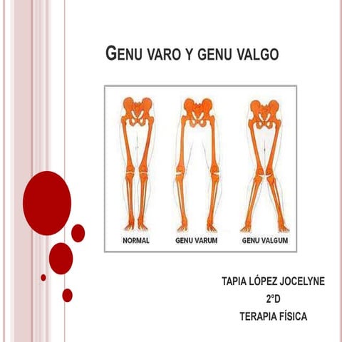 Geno varo y geno valgo ii | PPTX