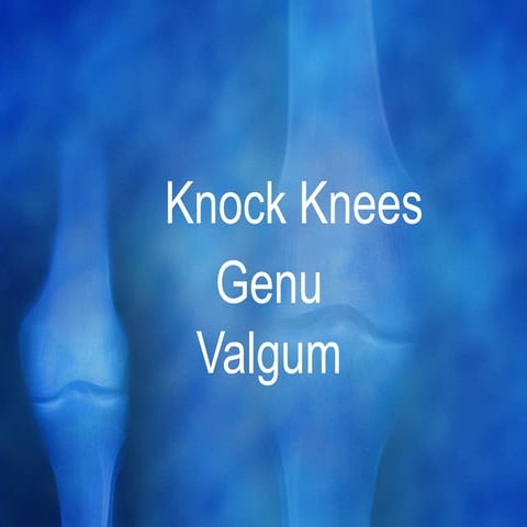 Genu varus and valgus | PPTX