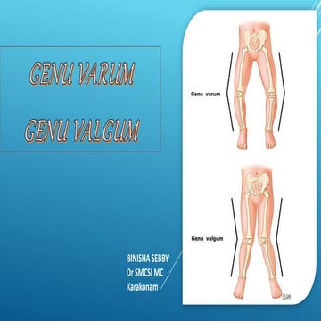 Genu varum valgus ,coxa varum | PPTX