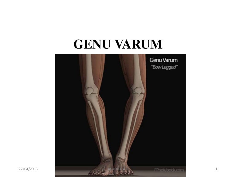 Genu Varum