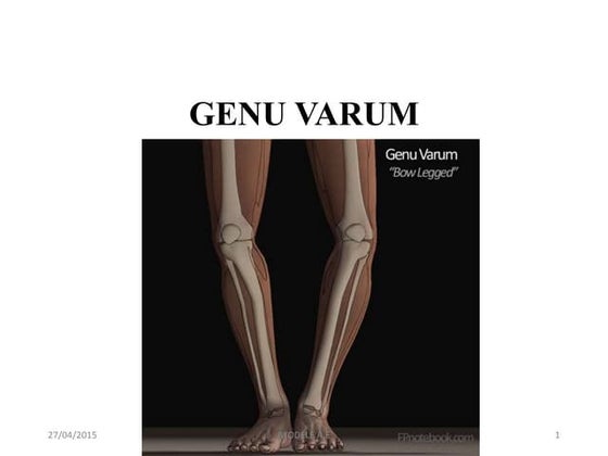 Genu varus and valgus | PPT
