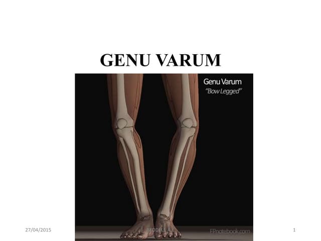 GENU VALGUM & VARUM.pptx