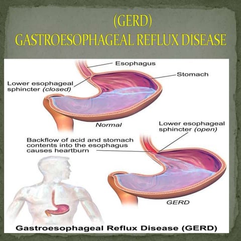 Gerd | PPT