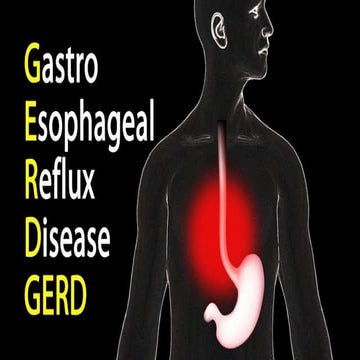 GERD | PPTX