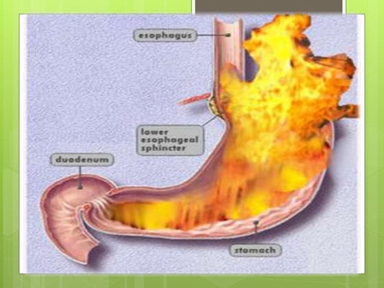 Gastro esophageal reflux disease (GERD) | PPT | Digestive Disorders ...