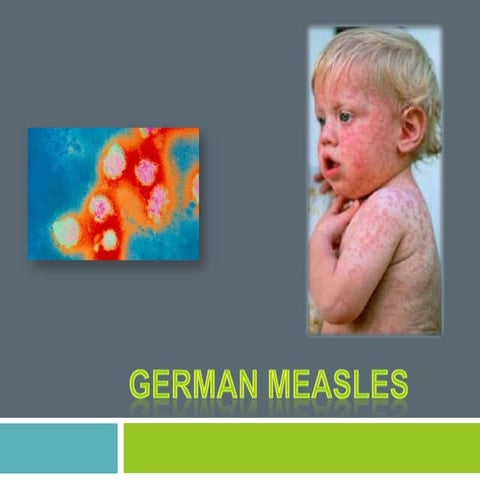 German measles | PPT
