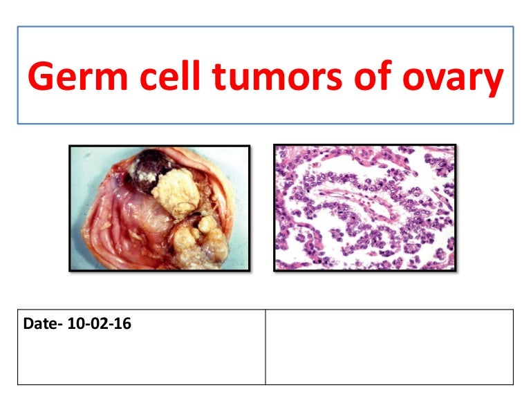 Germ Cell Tumors Of Ovary 
