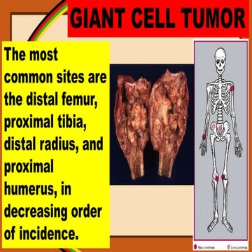 Giant cell tumor | PPTX