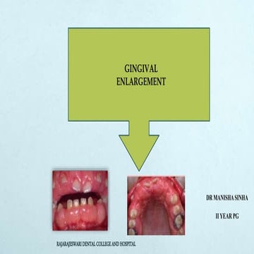 Gingival enlargement | PPTX
