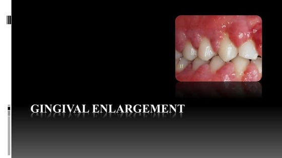 Pulp polyp and gingival polyp | PPT