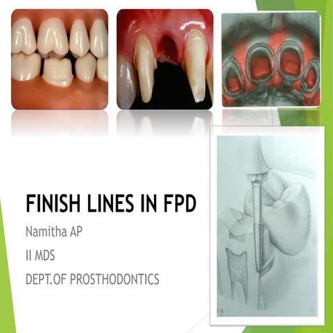 Gingival finish lines in fixed partial denture(FPD) with references | PDF