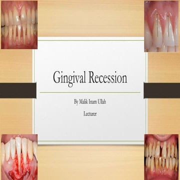Gingival Recession, Gums Recession, | PPTX