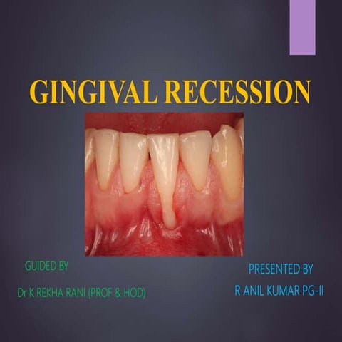 Gingival recession aries | PPT