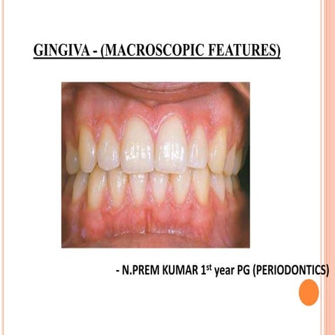 Gingiva (Macroscopic features) | PPTX