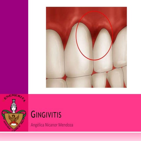 Gingivitis | PPTX