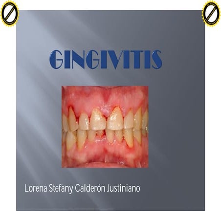 Gingivitis | PDF