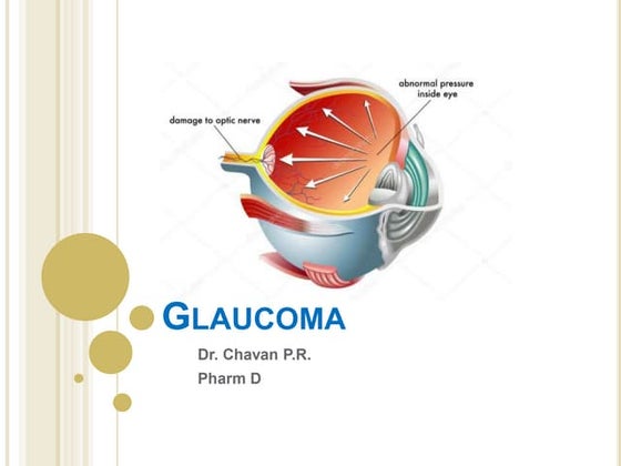 Glaucoma | PPT