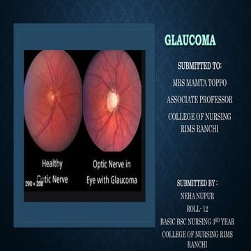 Glaucoma slideshare for medical students | PPTX