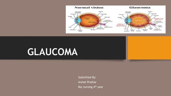 glaucoma and its management.pptx for nursing students | PPTX | Eye and Vision Conditions ...