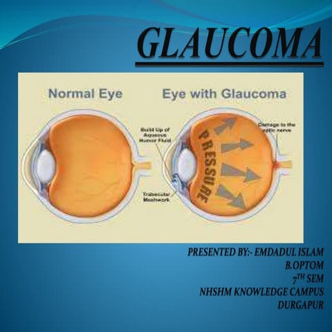 Glaucoma | PPTX