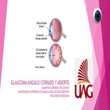 Glaucoma angulo cerrado y abierto | PPTX