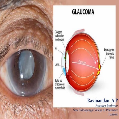 Glaucoma Definition, Introduction, Etiology, Epidemiology, Clinical Presentation, Diagnosis and ...